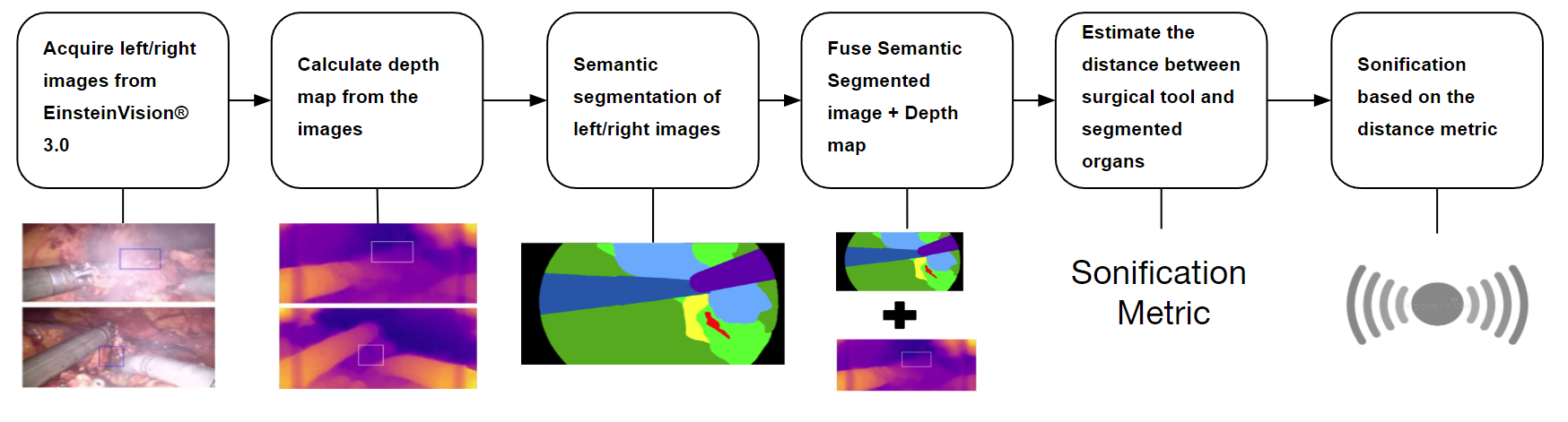 Distance Sonification For Laparoscopic Cholecystectomy Using Dense